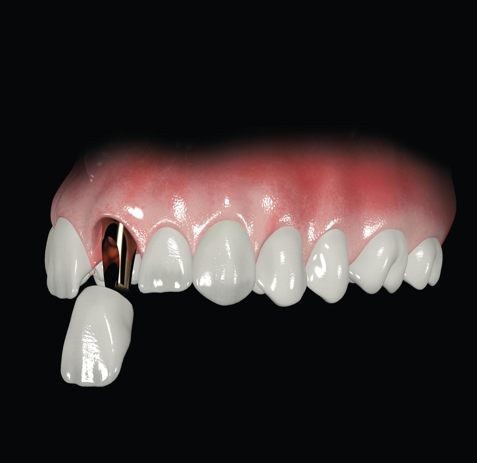 Single tooth restoration (Anterior Region) | Megagen