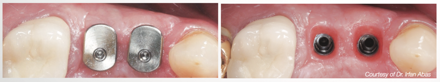 Anatomic Healing Abutment | Megagen